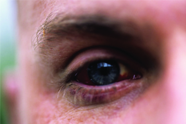 Diabetic Eye Disease - a leading cause of blindness and vision loss ...