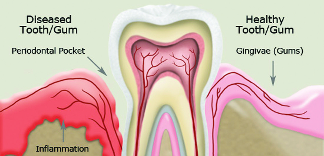 Gum Disease Linked to Autoimmune Disorders • Southwest Florida's Health ...