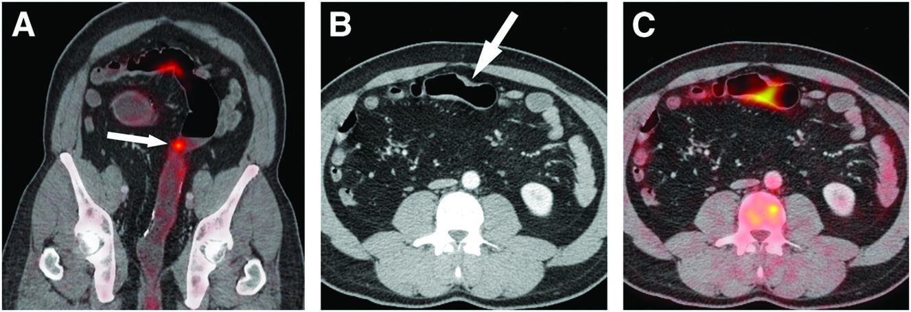 CT Enterography: Detect Crohn’s Disease and Other Bowel Abnormalities ...