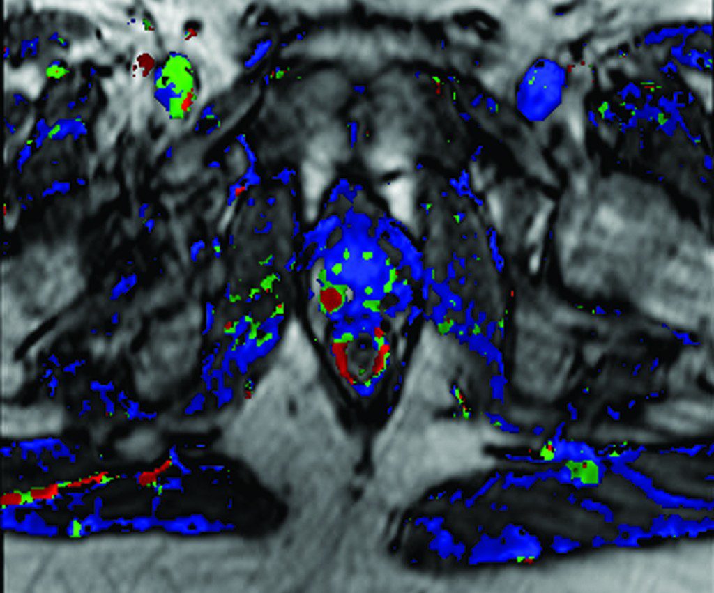 3T High Resolution Prostate MRI • Southwest Florida's Health and ...