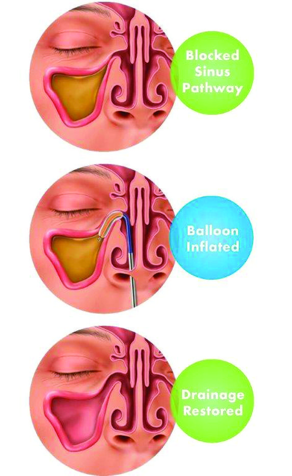 A Novel Way for Managing Your Chronic Sinus Disease • Southwest Florida ...