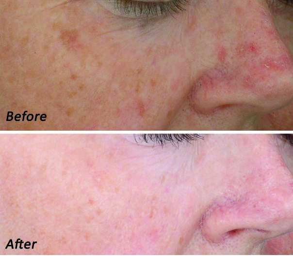 Seeing the Light - Latest Treatment for Precancers Uses Photodynamic ...