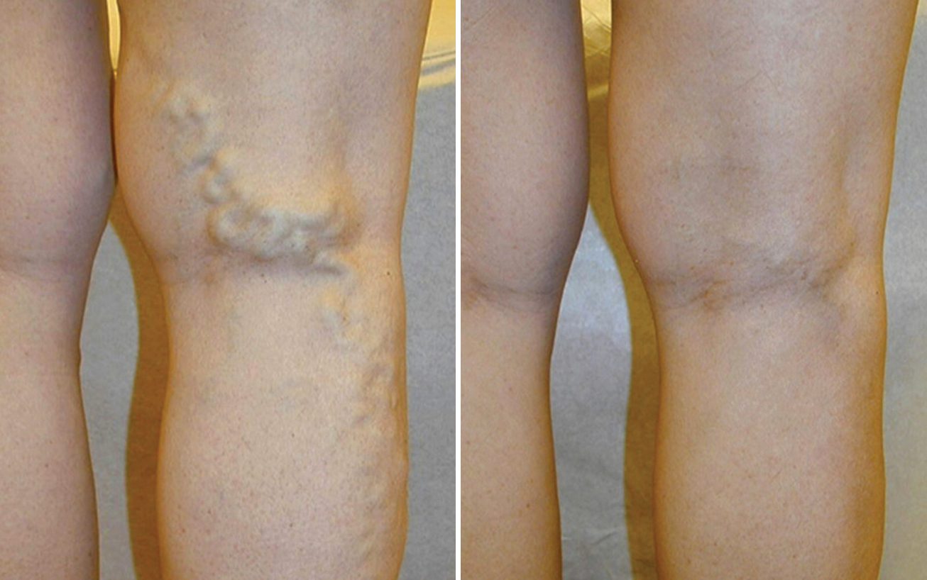 20 REASONS TO FIX YOUR VEINS • Southwest Florida's Health and Wellness ...