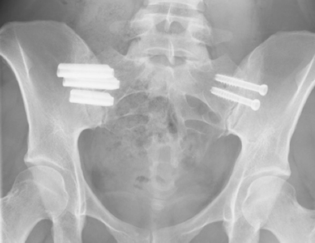 Sacroiliac (SI) Joint Dysfunction • Southwest Florida's Health and ...