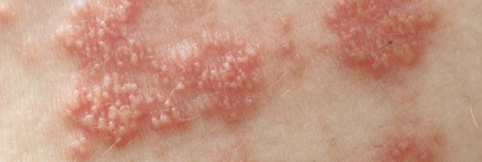 How to Shorten the Duration of a Shingles Outbreak • Southwest Florida ...