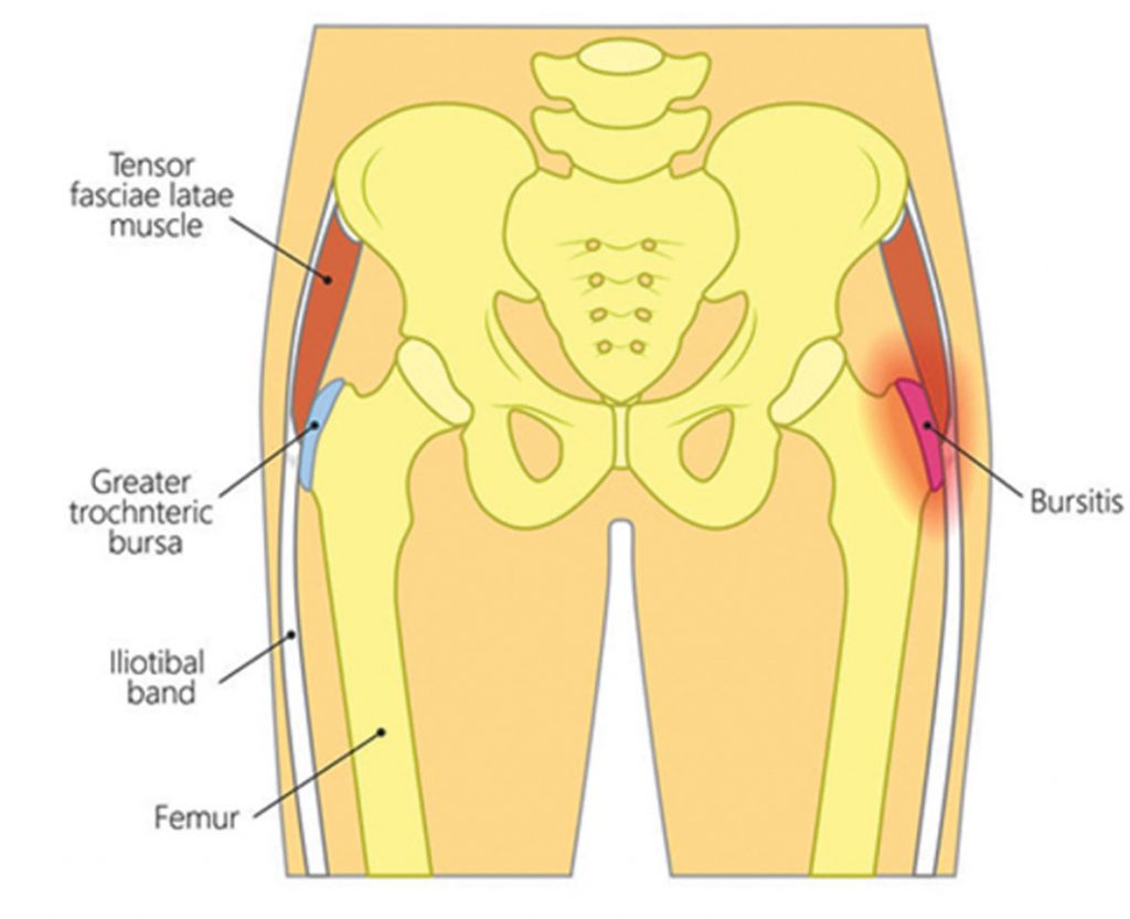 Hip Bursitis • Southwest Floridas Health And Wellness Magazine