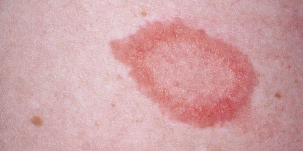 Christmas Tree Rash • Southwest Florida's Health and Wellness Magazine