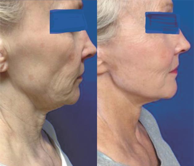 When it's time for a “surgical” neck lift • Southwest Florida's Health ...