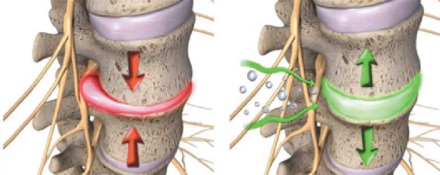 The “Ultimate” Spine care and Spinal Decompression Program • Southwest ...