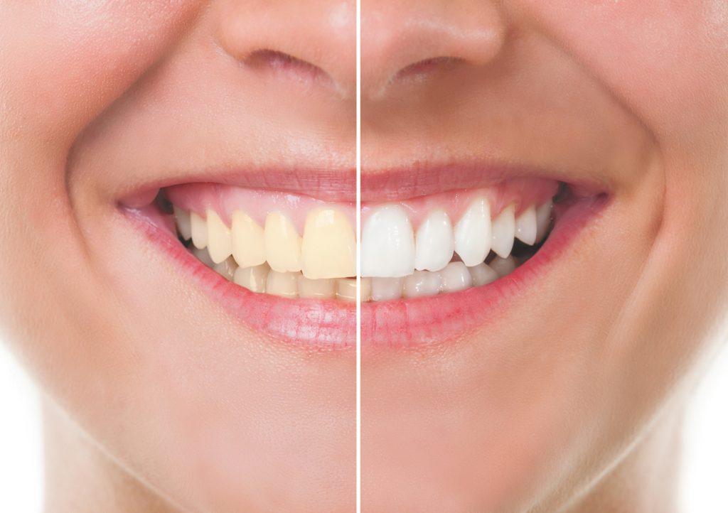 Everything You Need to Know About Tooth Whitening • Southwest Florida's ...