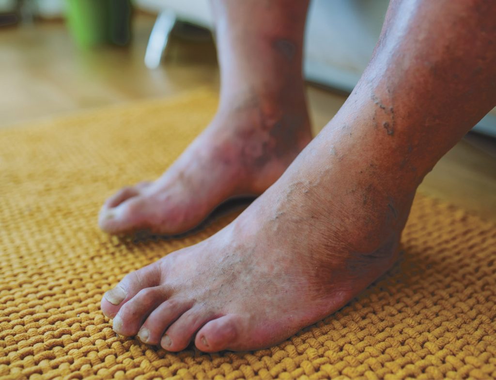 Diabetic Foot Infections and Preventing Amputation • Southwest Florida ...
