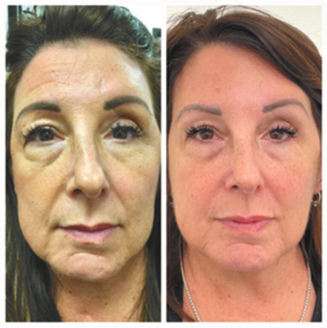 Achieving Your Best Self: Managing Loose Skin After Successful Weight ...