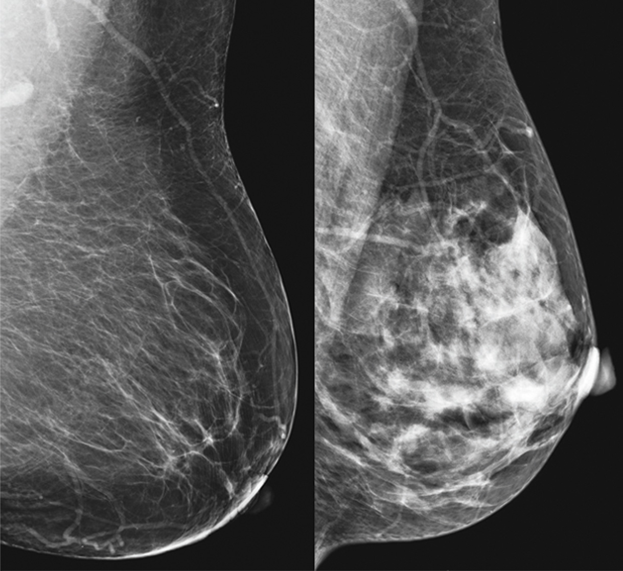 Understanding Breast Density on Mammograms: What It Means and When to ...
