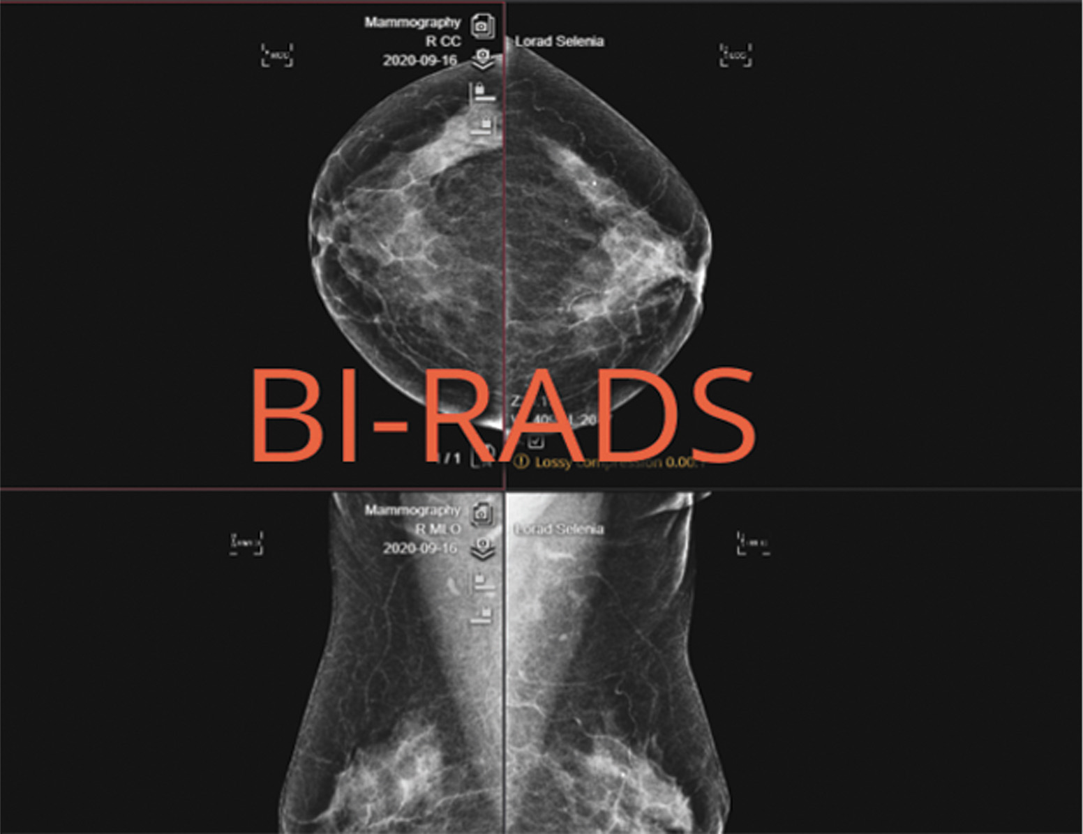 Understanding the BI-RADS Classification: The Language of Mammograms ...